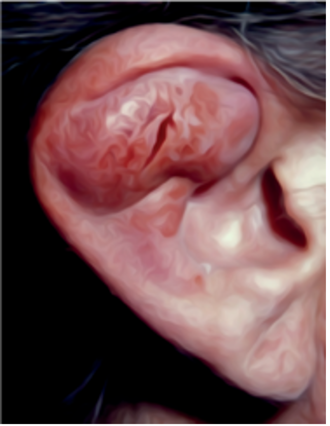 Ear health – Learning on TAP