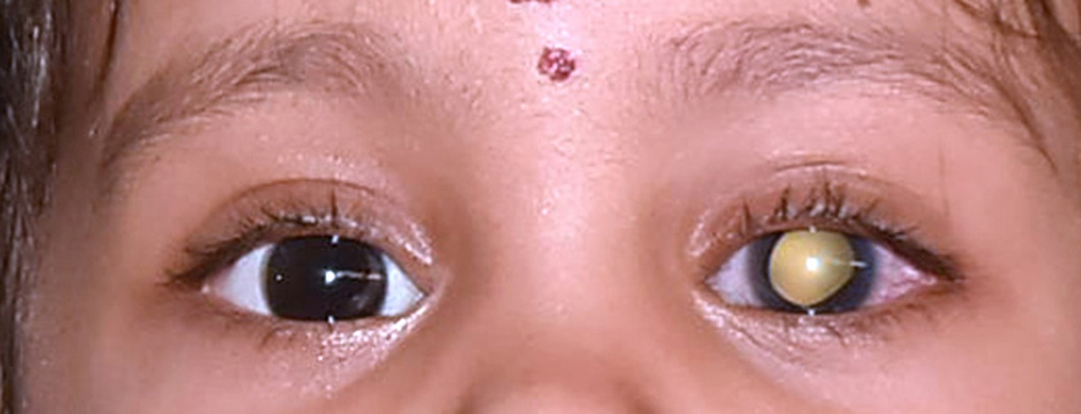 How to carry out a fundus reflex screen in children three years and ...